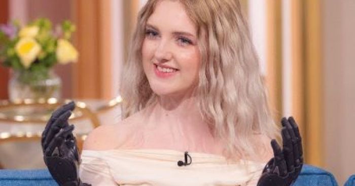 Teen With The World's Most Advanced Bionic Hands | Klipland.com